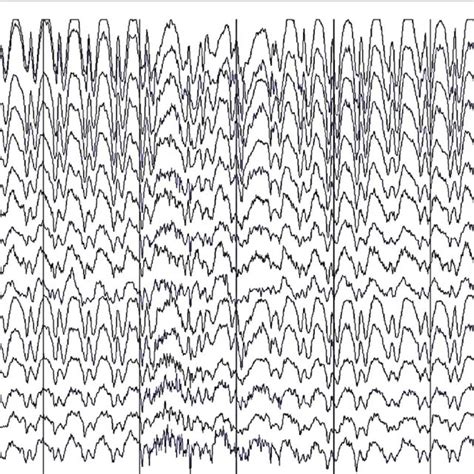 Eeg Recordings Of Case 2 A Generalized 4 To 7 Hz Spike And Wave Download Scientific Diagram