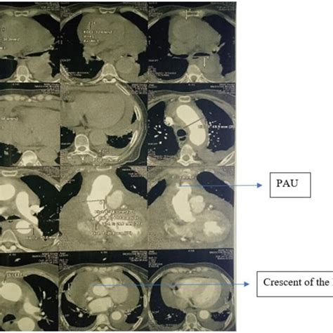 Thoracic Angioscanner Showing A Dilated Thoracic Aorta Without Intimal