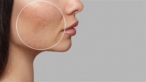 Apakah Bopeng Bisa Dihilangkan Dengan Skincare