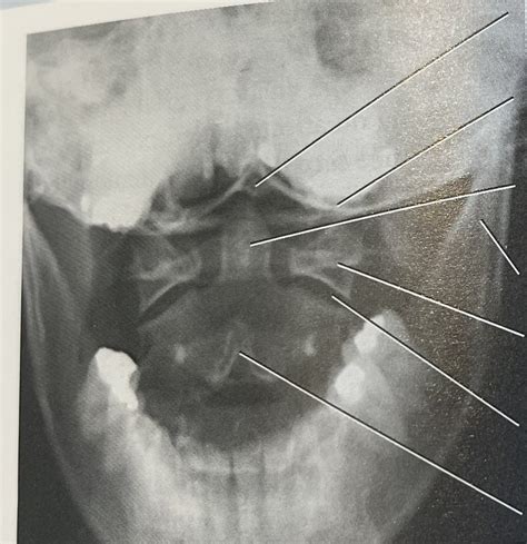 Label Odontoid Diagram Quizlet