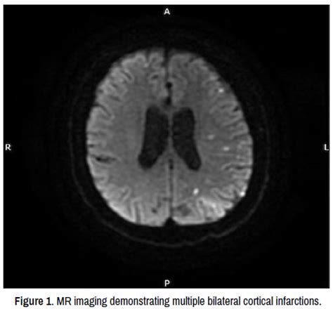 Vasculitis Infarctions