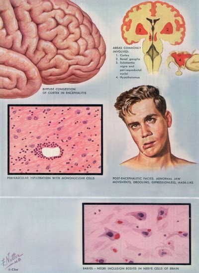 Frank H Netter 1906 1991 Netter Is The Norman Tumbex