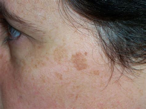 Flat Pink Spots On Skin