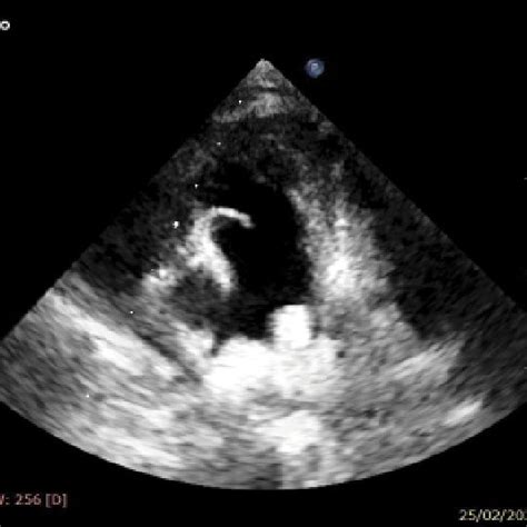 Shows Moderately Tortuous Ductus Arteriosus Pda With Three Bends Download Scientific Diagram