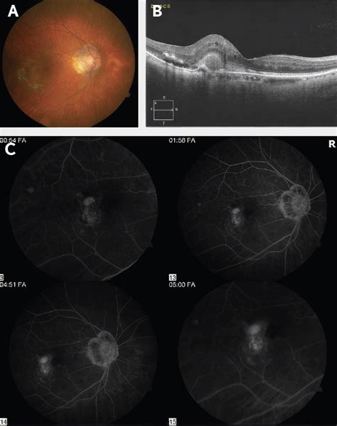 Management Of Predominantly Classic Choroidal Neovascularization Due To The Polypoidal Choroidal