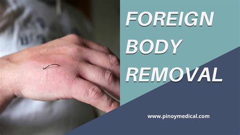 Foreign Body Removal Price In The Philippines 2025 PinoyMedical