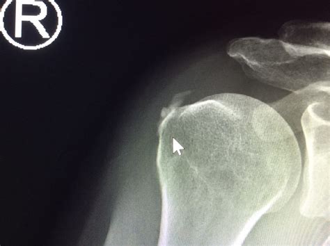 Calcific Tendonitis Dr Chris Jones Colorado Springs Co