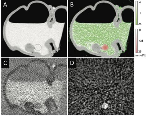 Spectral Photon Counting Ct Initial Experience With Dual Contrast