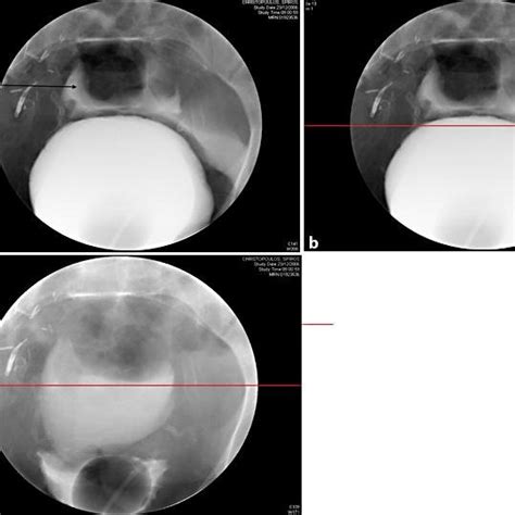 Cystogram With Contrast In The Urinary Bladder And Early Escape Of Download Scientific Diagram