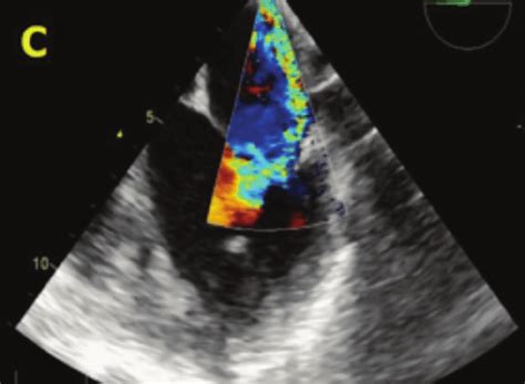Papillary Muscle Rupture Secondary To Acute Myocardial Infarction A B Download Scientific