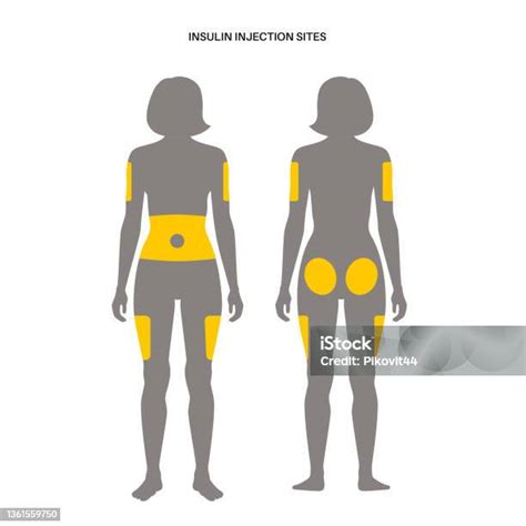 Insulin Injection Sites向量圖形及更多注射圖片 注射 皮下的 針筒 Istock