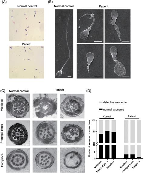 The Multiple Morphological Abnormalities Of The Sperm Flagella Mmaf