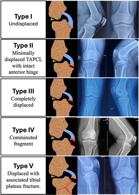 A Modified Classification Of Tibial Avulsion Of The Posterior Cruciate