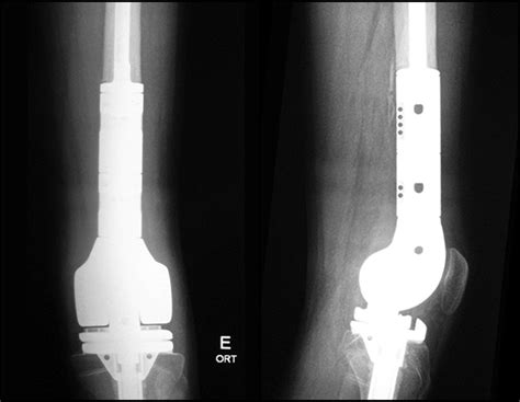 Custom Made Prostheses Oncosurgery