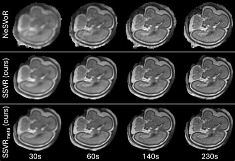 Meta Learning Slice To Volume Reconstruction In Fetal Brain Mri Using