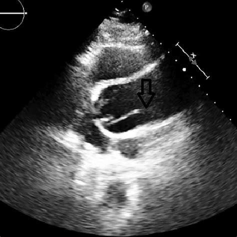 Intimal Flap Dissection In The Aortic Lumen Observed At Download Scientific Diagram