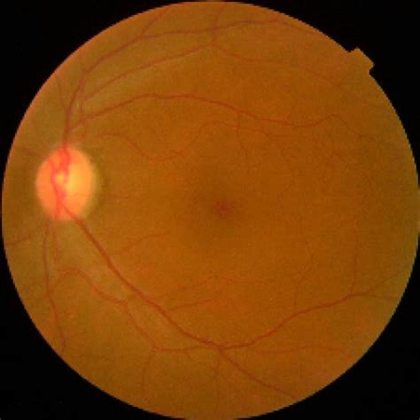 Detection Of Diabetic Retinopathy Using Machine Learning Classification Model V Retinopath