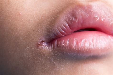 Granulomatous Cheilitis Miescher Cheilitis Causes And Treatment
