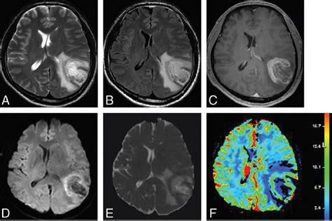 Tumefactive Demyelinating Lesions A Literature Review Of Recent Findings Neurosciences Journal