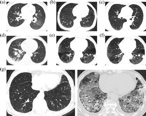 First‐line Chemoimmunotherapy For Patients With Small‐cell Lung Cancer And Interstitial Lung