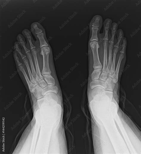 Poster Medical X Ray Revealing Normal Foot And Ankle Bone Alignment