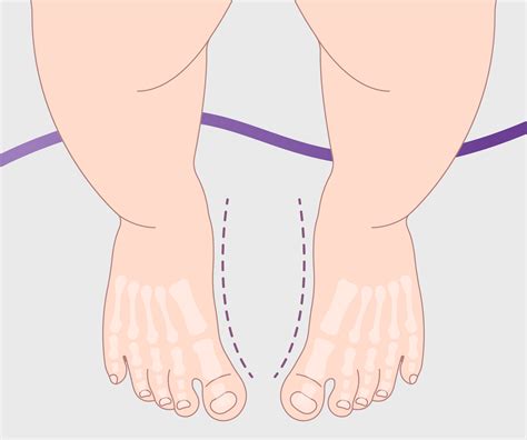 Metatarsus Adductus Causes Symptoms Treatment