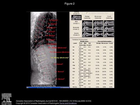 Combined Vertebral Fracture Assessment And Bone Mineral Density