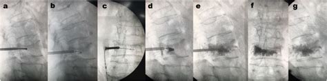 Comparison Of Percutaneous Curved Kyphoplasty And Bilateral