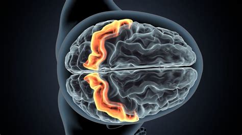 Brain Stem Glioma Symptoms 10 Key Signs Of Brainstem Tumors