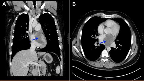 Multimodal Imaging And Management Of A Metastatic Cardiac Intimal Sarcoma Case