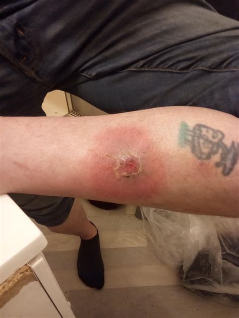 Spider Bites Or Cellulitis Rmedicaladvice