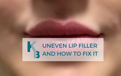 Uneven Lip Filler And How To Fix It