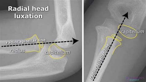 Radiocapitellar Line Wikism Sports Medicine Wiki