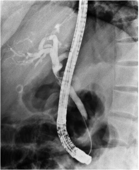 A Stricture Just Distal To The Common Hepatic Duct Confluence And Download High Resolution