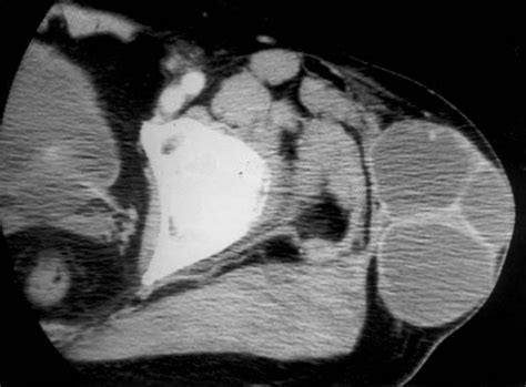 Nodular Fascitis Eurorad