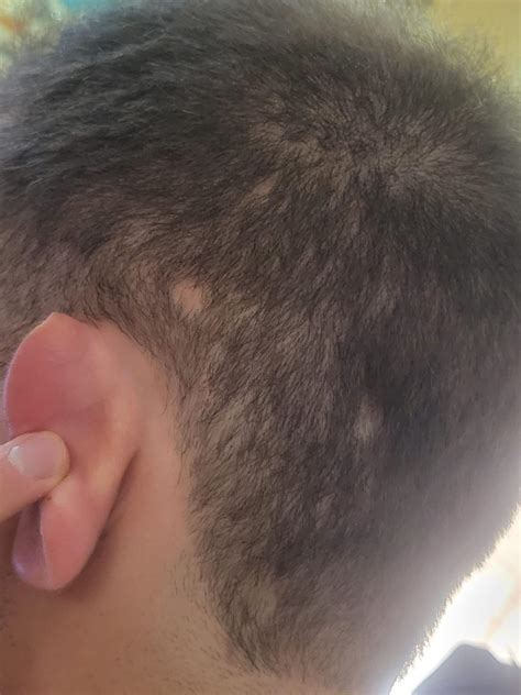 Patches In Donor Area That Only Appeared At ~3 Months Post Ht What Is It To Note Important