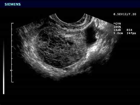 Test GYN Flashcards Quizlet