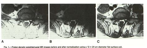 Figure 1 From Signal Normalization In Surface Coil Mr Imaging Semantic Scholar