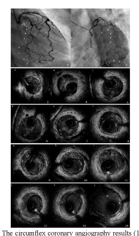 Pdf Acute Myocardial Infarction In A Middle Aged Female Caused By