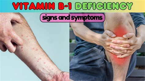 Vitamins Deficiency Symptoms Vitamin B1 Thiamine Deficiency Symptoms