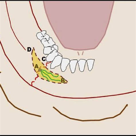 Pdf Comparison Of Two Incisions For Open Reduction And Internal Fixation Of Mandibular Body