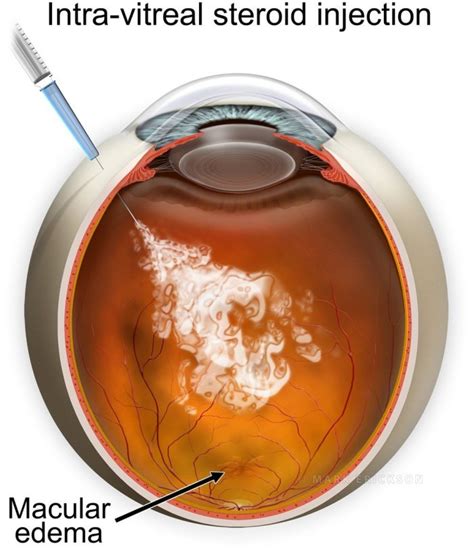 Intravitreal Triamcinolone Eye Injection Cross Section Eyeball Illustration