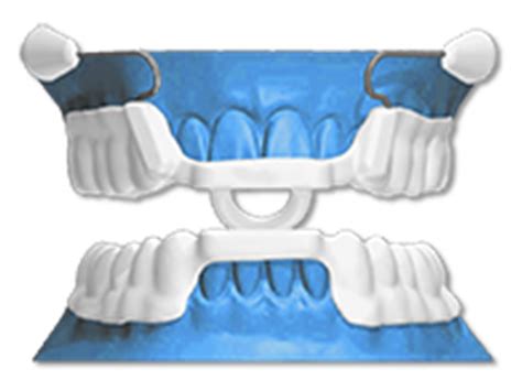 Occlusal Splint Therapy Cairns Tmd Treatment Future Dental