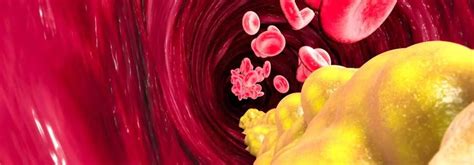 Experimental Drug Olezarsen May Reduce Hypertriglyceridemia In High Risk Patients Nejm