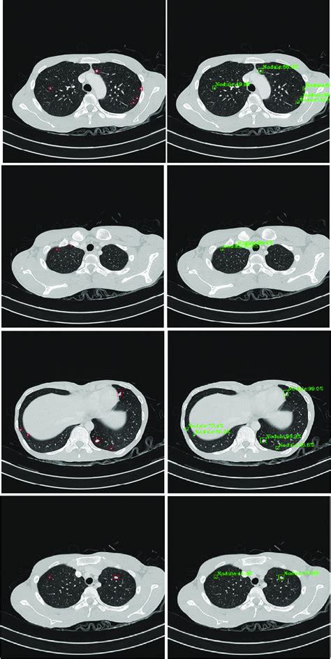 Nodules Locations Predicted By The Trained Ssd Vgg16 Download Scientific Diagram