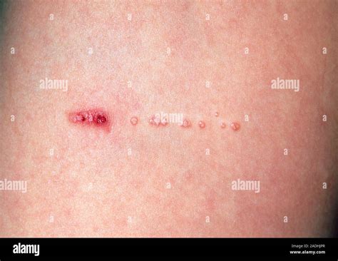 Molluscum Contagiosum View Of A Line Of Lesions On The Skin Of A 10