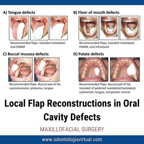 Maxillofacial Surgery Local Flap Reconstructions In Oral Cavity Defects An Insight From 104 Cases