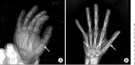 Figure 1 From Radiologic Prevalence And Features Of Metacarpal Pseudoepiphysis On Normal Korean