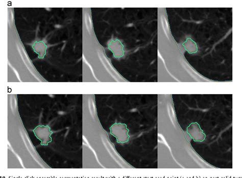 Figure From Automated Delineation Of Lung Tumors From CT Images Using A Single Click Ensemble