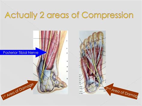 Peripheral Nerve Compression Syndrome